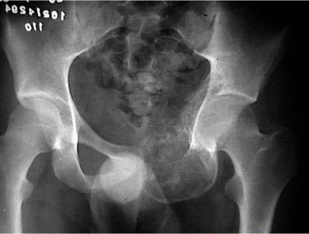 Chondrosarcoma - Pathology - Orthobullets